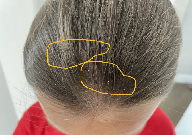 LiceDoctors Customer Service FAQs - Get Answers to Your Lice Removal Questions